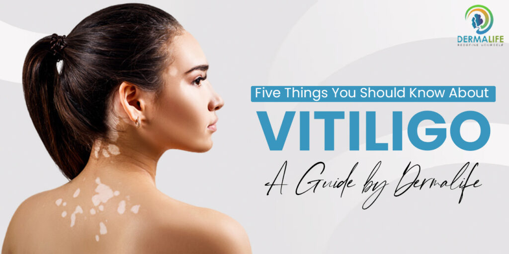 White Spots On Skin- Causes, Symptoms & Treatment